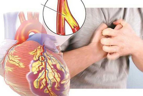 Người bệnh tim nguy cơ mắc bệnh tim như người cao tuổi